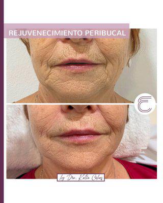 Arrugas peribucales o código de barras | Clinica Elysian